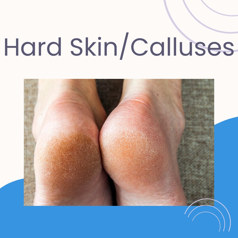 Hard Skin/Calluses Treatment Ballinasloe - ShopBallinasloe.ie